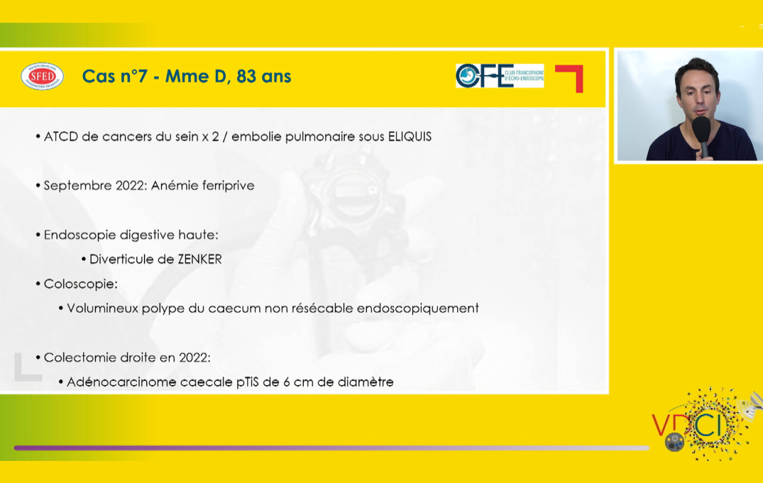 LIVE VIDEO-DIGEST 2023 : Myotomie endoscopique du muscle crico ...
