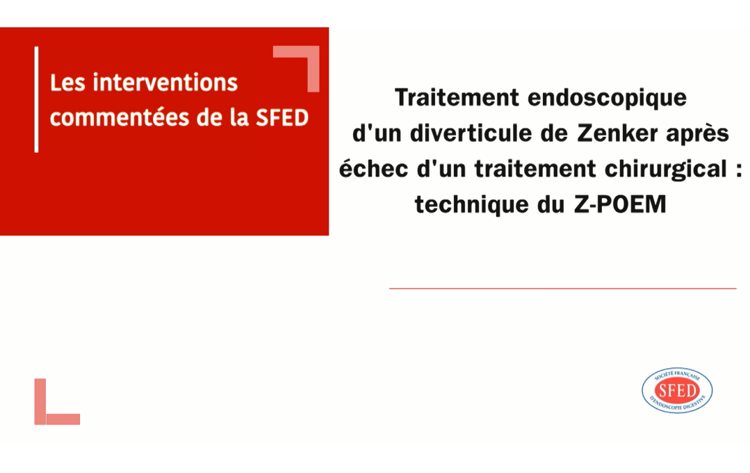 Traitement endoscopique d’un diverticule de Zenker après échec d’un ...