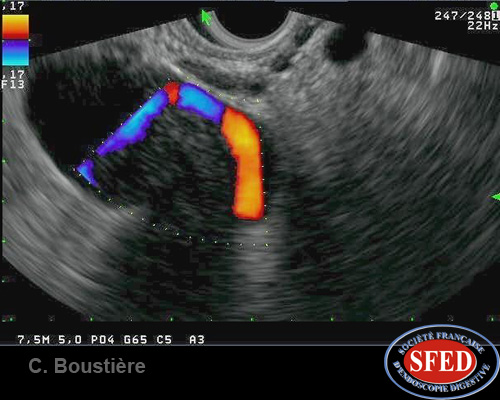 Thrombose porte partielle – SFED